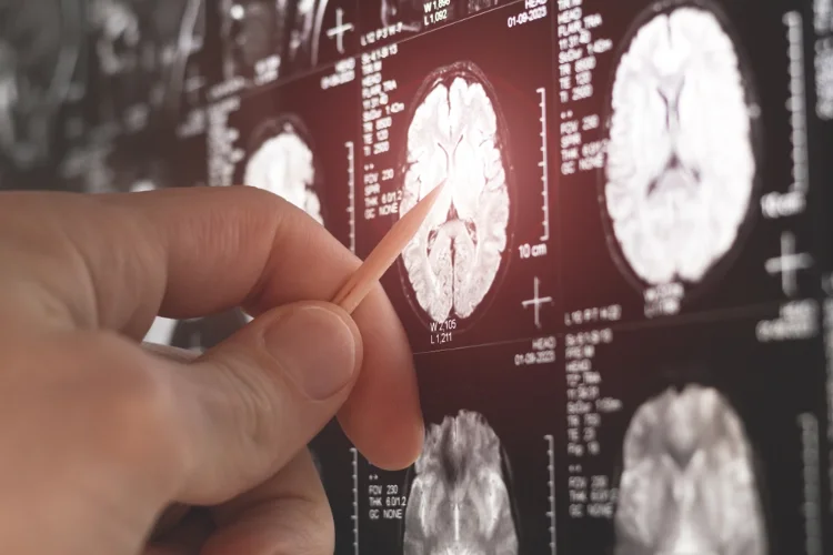 Researchers Study Man with 90% Brain Loss Living a Normal Life